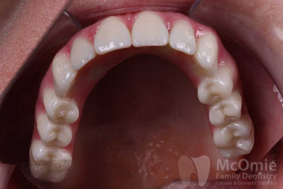 Teeth Replacement Alternatives To Dental Implants - McOmie Dentistry ...