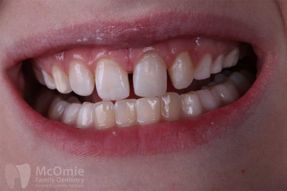 Resin Bonding Patient Before and Afters - McOmie Dentistry Chattanooga