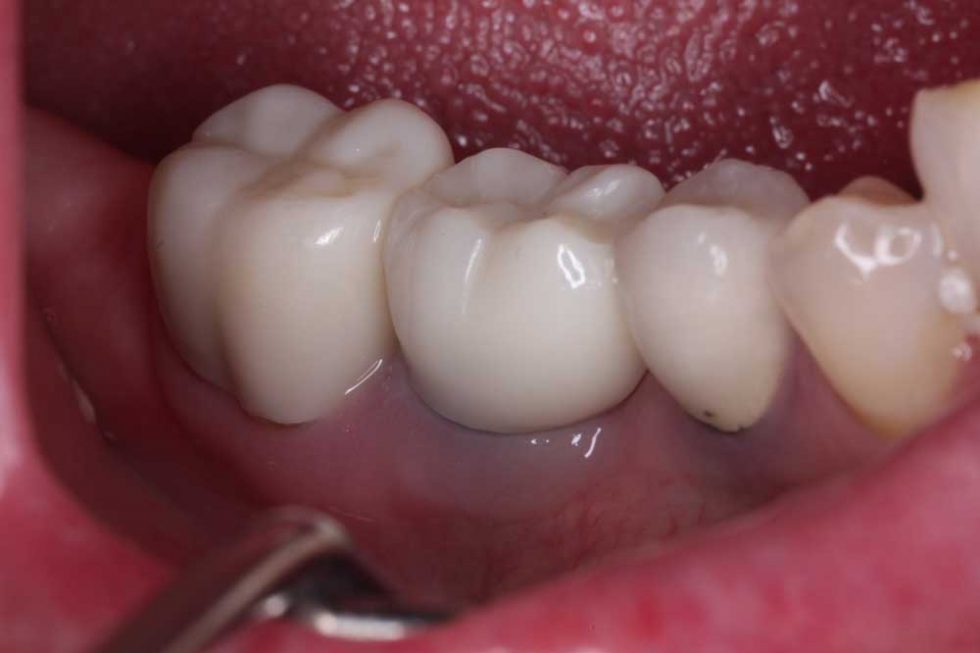 Implant dentistry Case Study - McOmie Family Dentistry