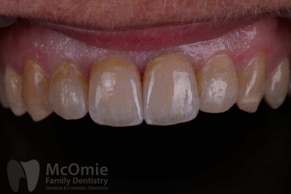 Dental Trauma Restorations Patient Before and Afters - McOmie Family ...