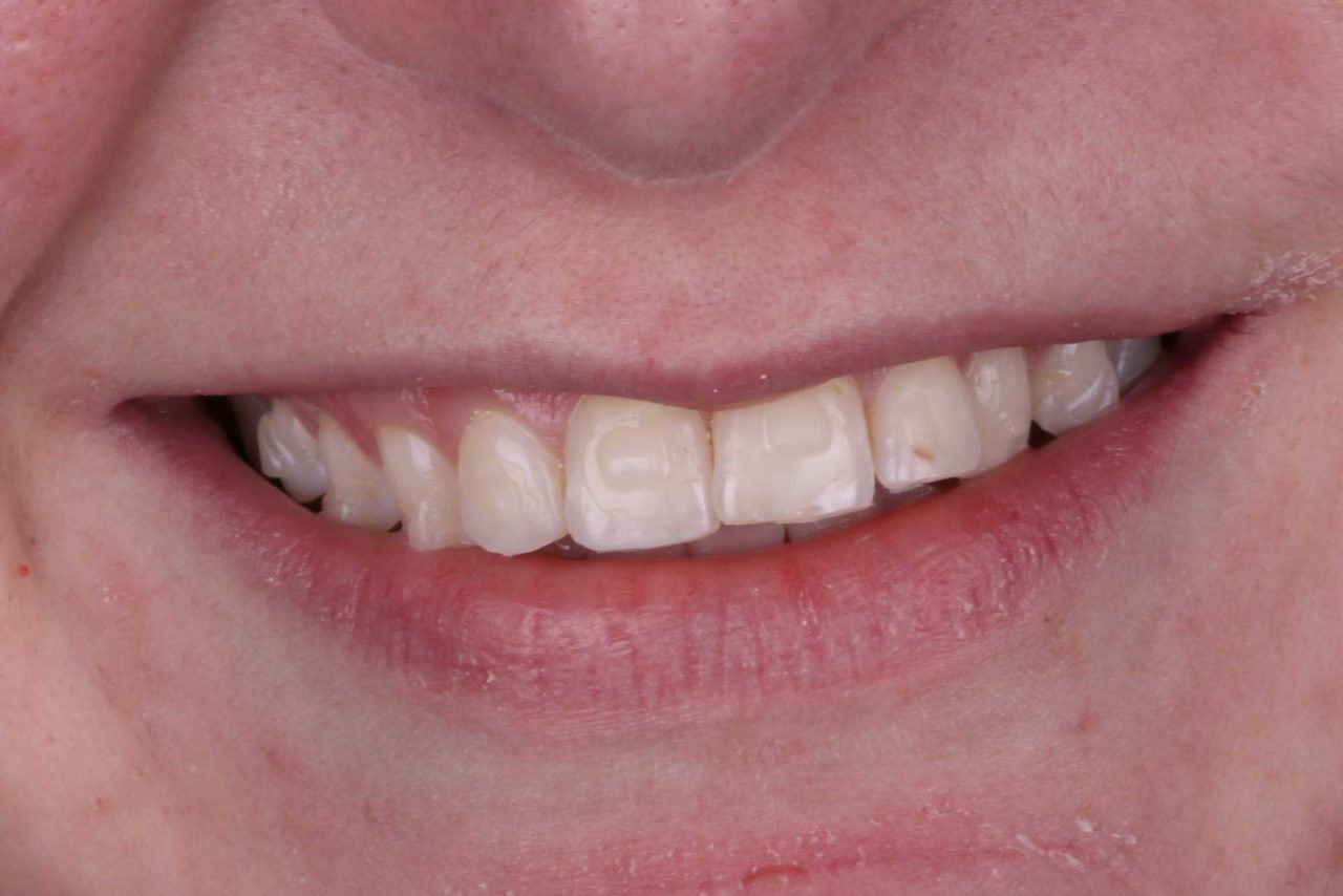 Veneers Patient Before and Afters - McOmie Family Dentistry