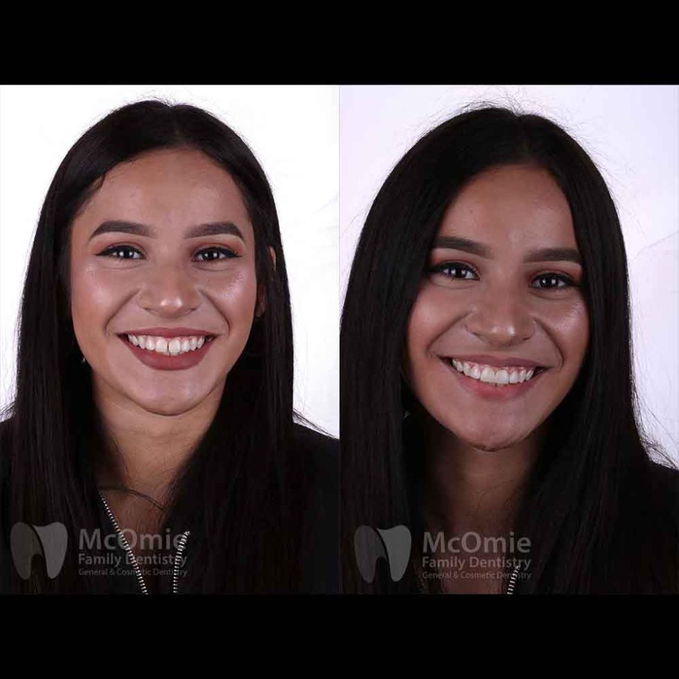 Resin Bonding Patient Before and Afters - McOmie Dentistry Chattanooga