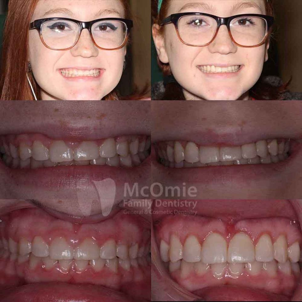 Cosmetic Gingival Recontouring Patient Before and Afters - McOmie ...