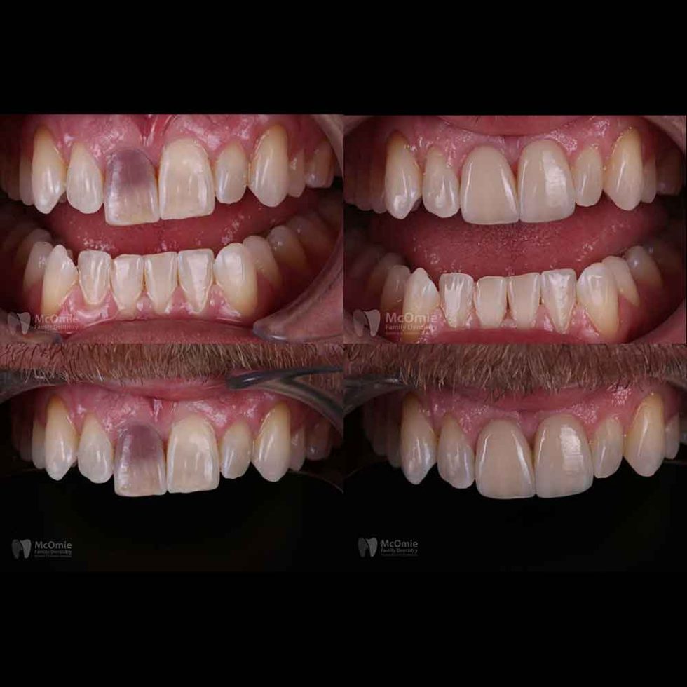 Dental Trauma Restorations Patient Before and Afters - McOmie Family ...