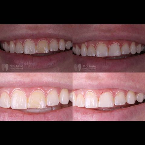 Resin Bonding Patient Before and Afters - McOmie Dentistry Chattanooga