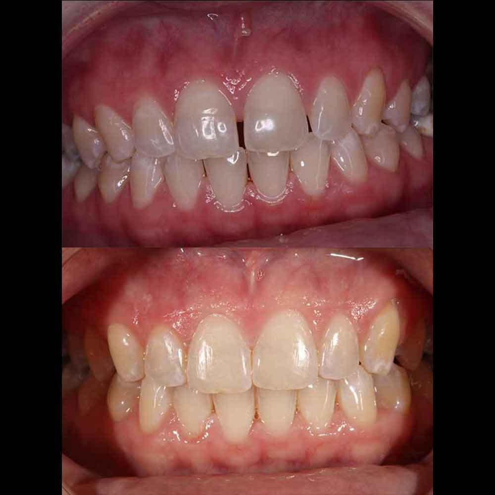 Clear Correct Aligners Patient Before And Afters McOmie Dentistry