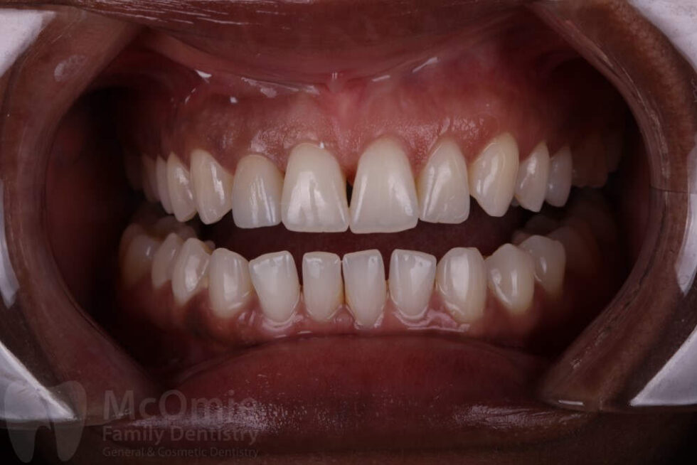 Dental Crowns and Bridges Before and After - McOmie Dentistry Chattanooga