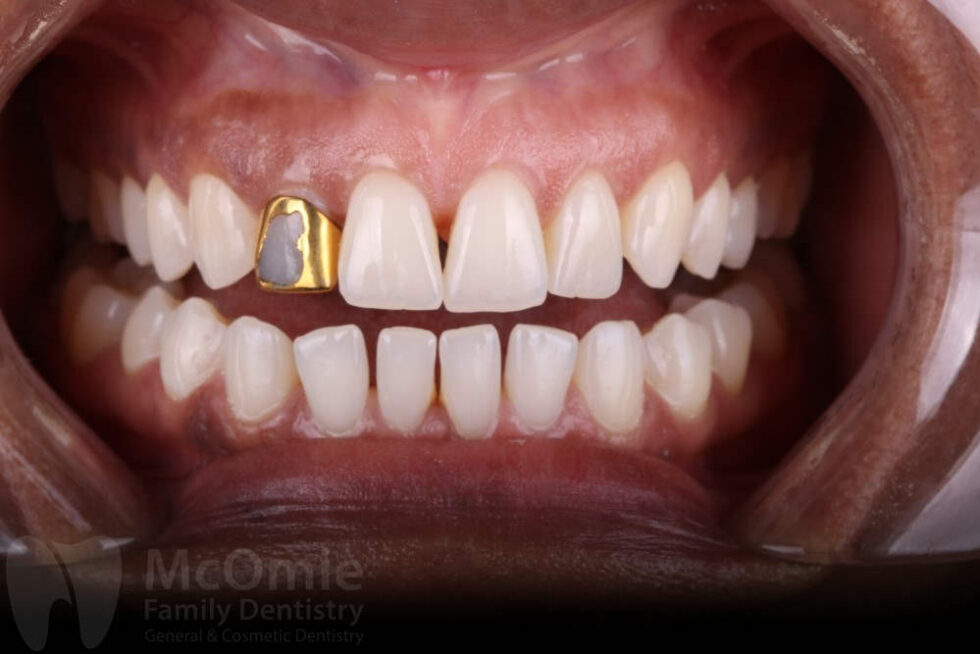 Dental Crowns and Bridges Before and After - McOmie Dentistry Chattanooga