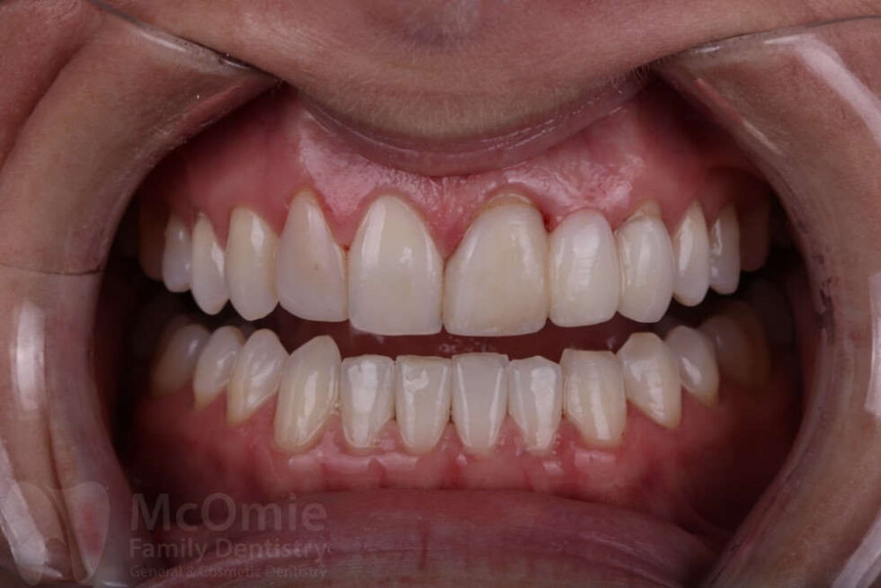Dental Crowns and Bridges Before and After - McOmie Dentistry Chattanooga