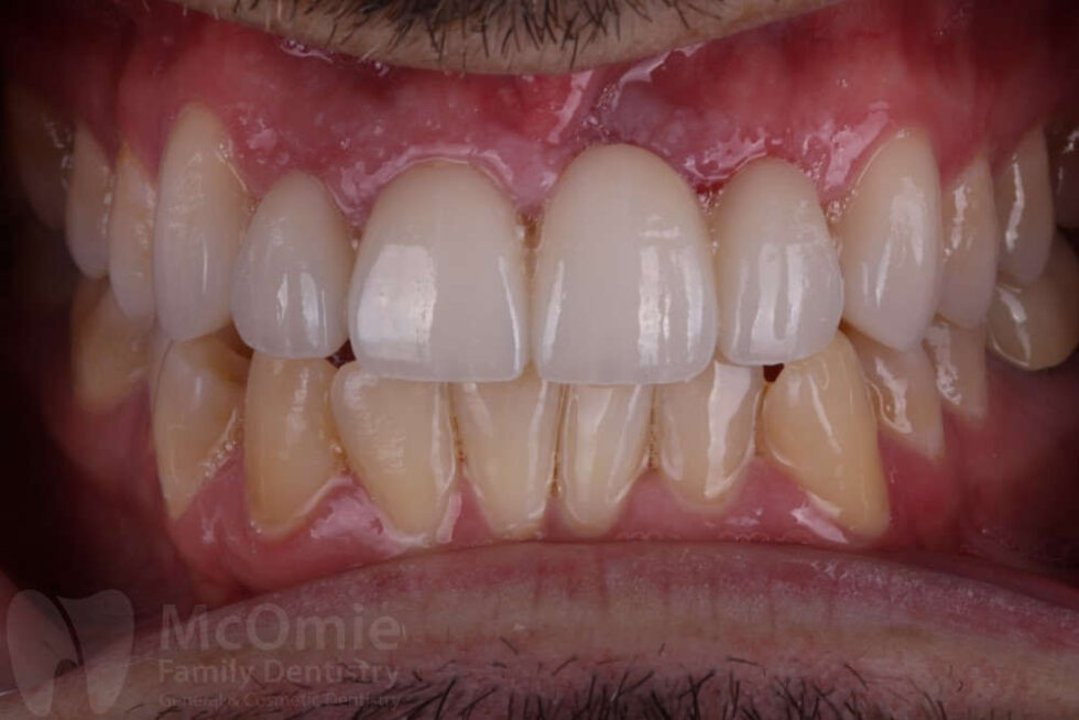 Dental Crowns and Bridges Before and After - McOmie Dentistry Chattanooga