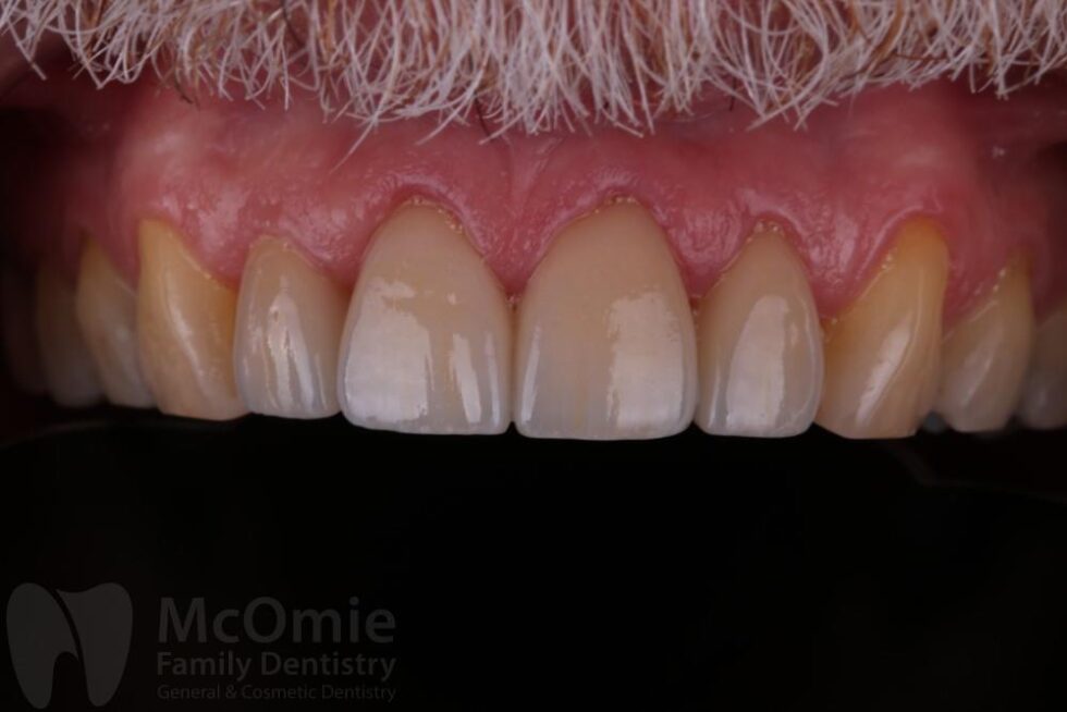 Dental Trauma Restorations Patient Before and Afters - McOmie Dentistry ...