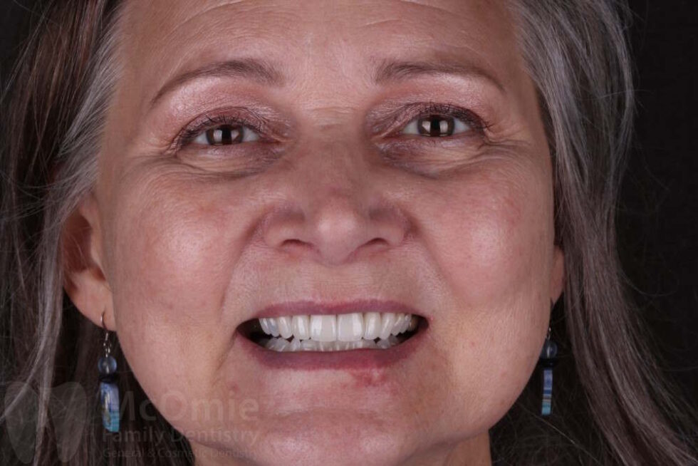 Dental Trauma Restorations Patient Before and Afters - McOmie Dentistry ...