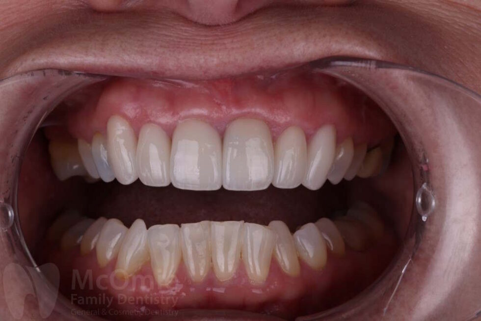 Dental Trauma Restorations Patient Before and Afters - McOmie Dentistry ...