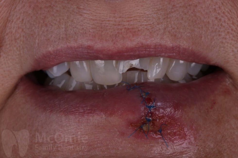 Dental Trauma Restorations Patient Before and Afters - McOmie Dentistry ...
