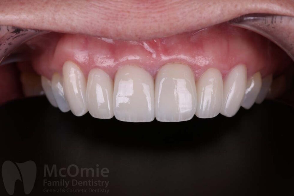 Dental Trauma Restorations Patient Before and Afters - McOmie Dentistry ...