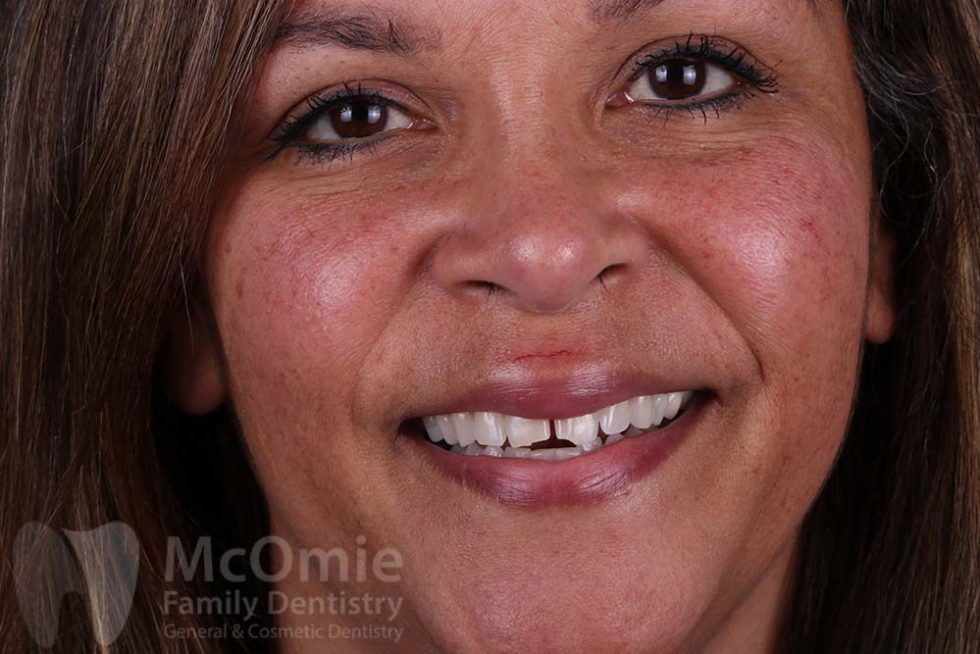 Dental Trauma Restorations Patient Before and Afters - McOmie Dentistry ...