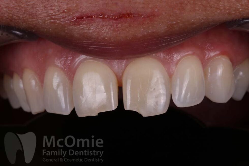 Dental Trauma Restorations Patient Before and Afters - McOmie Dentistry ...