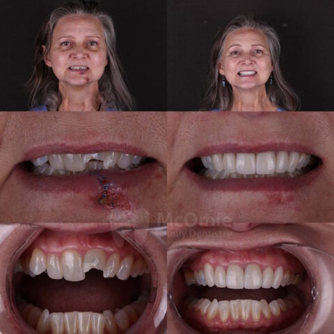 Dental Trauma Restorations Patient Before and Afters - McOmie Dentistry ...