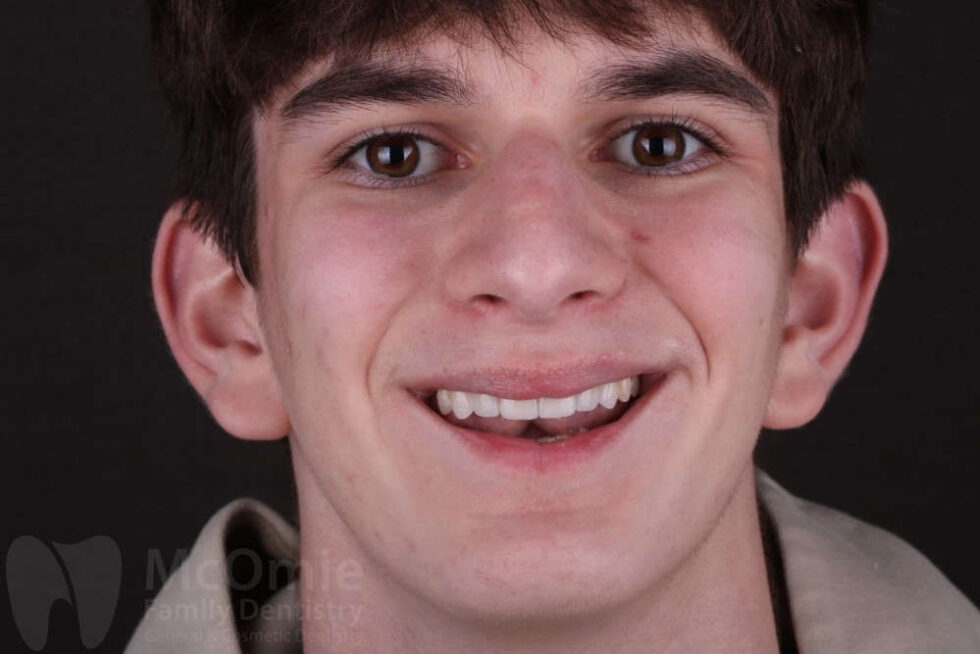 Veneers Patient Before and Afters - McOmie Family Dentistry