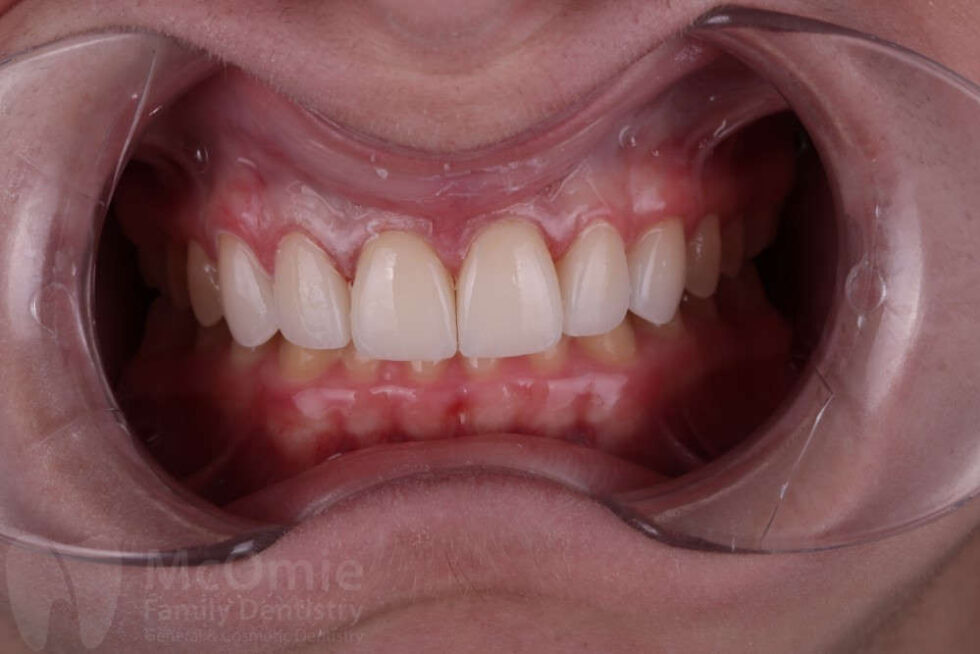 Veneers Patient Before and Afters - McOmie Family Dentistry