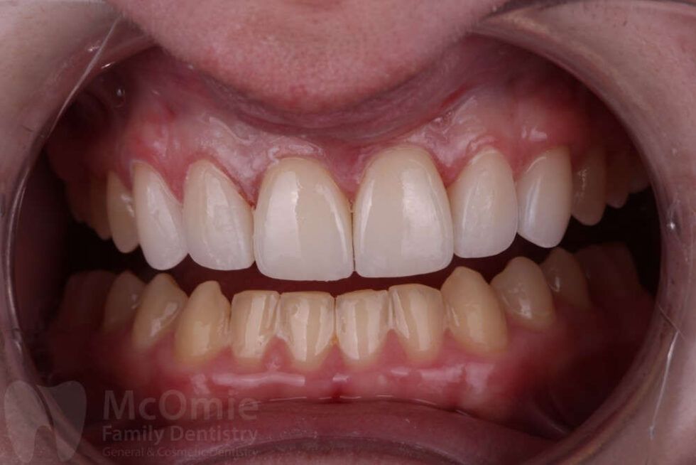 Veneers Patient Before and Afters - McOmie Family Dentistry