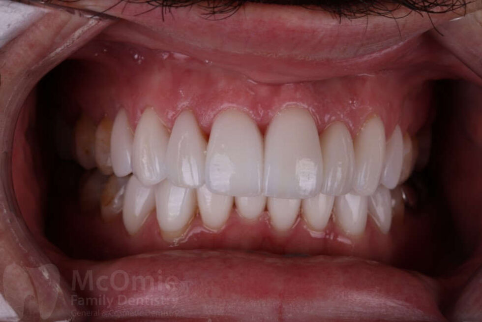 Veneers Patient Before and Afters - McOmie Dentistry Chattanooga