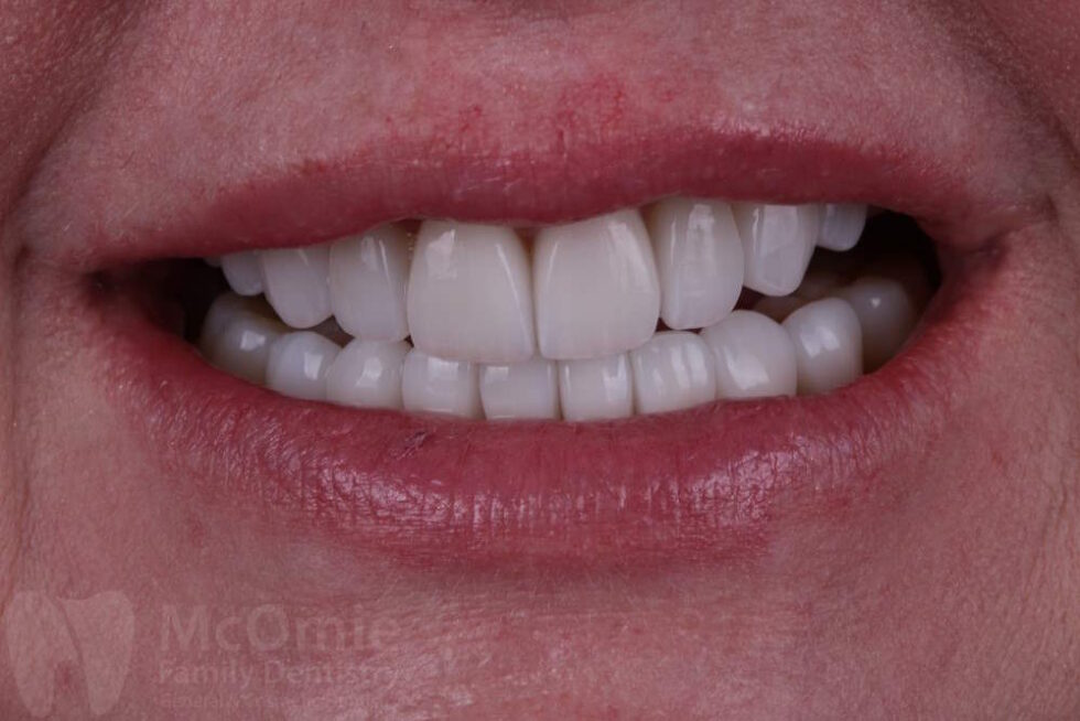 Veneers Patient Before and Afters - McOmie Family Dentistry