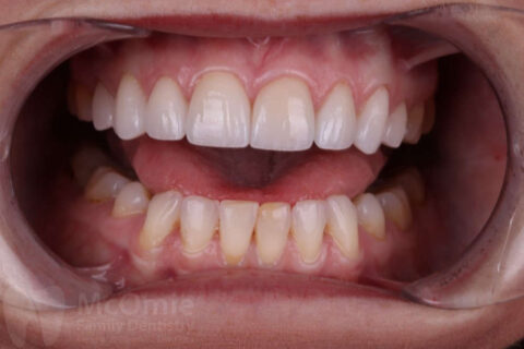 Veneers Patient Before and Afters - McOmie Dentistry Chattanooga