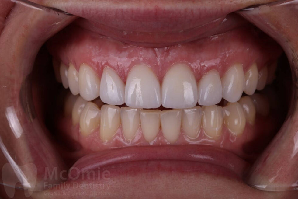 Veneers Patient Before and Afters - McOmie Dentistry Chattanooga