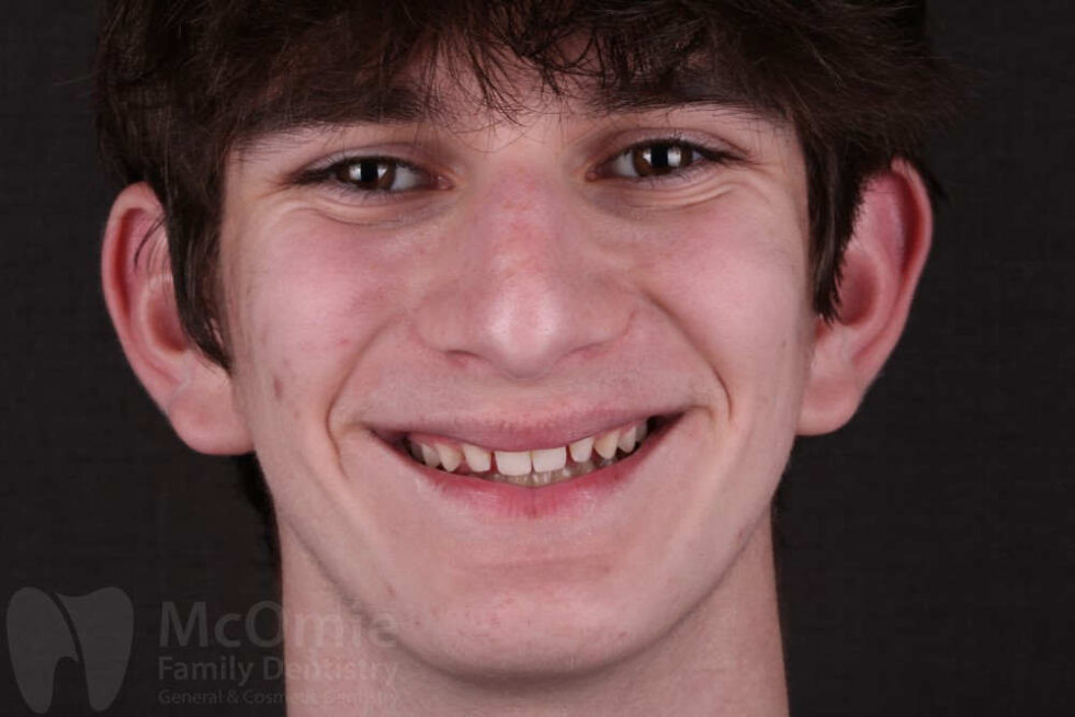 Veneers Patient Before and Afters - McOmie Family Dentistry