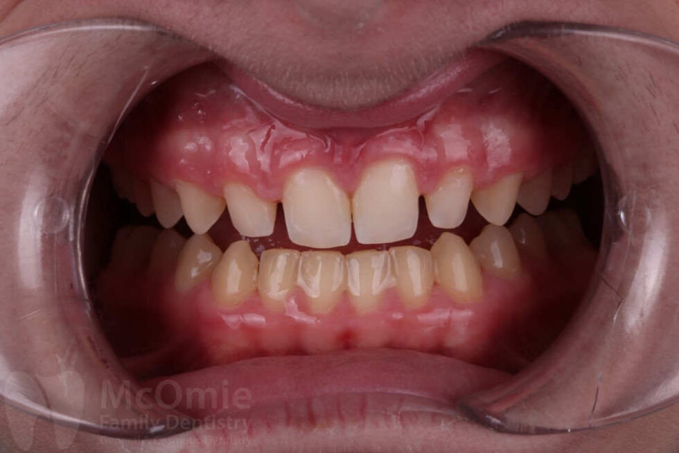 Veneers Patient Before and Afters - McOmie Family Dentistry