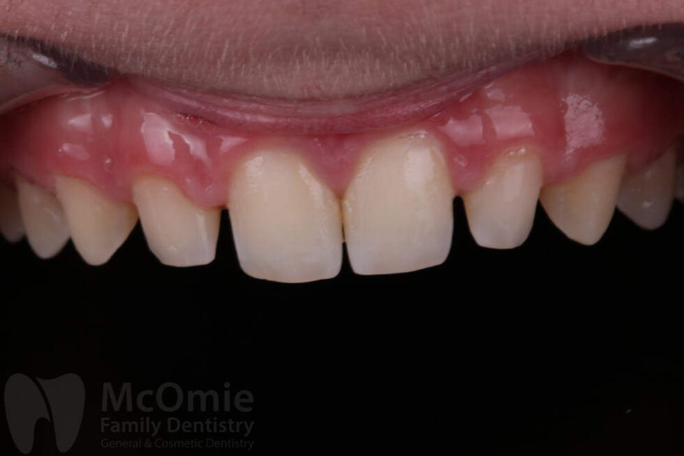 Veneers Patient Before and Afters - McOmie Family Dentistry