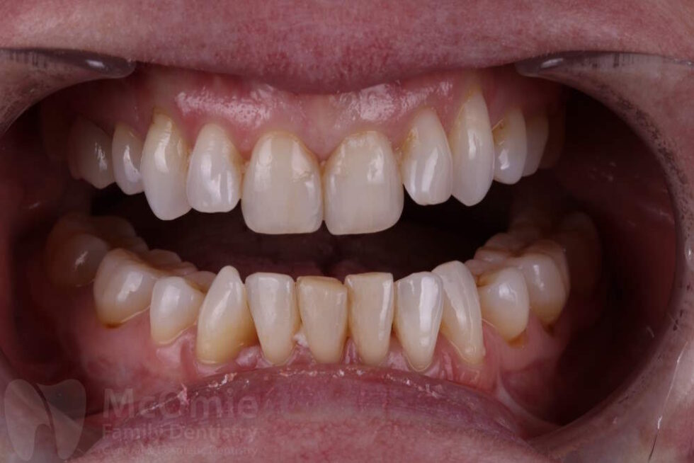 Veneers Patient Before and Afters - McOmie Family Dentistry