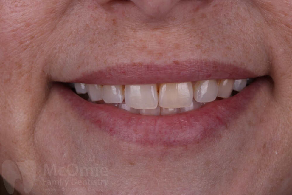 Veneers Patient Before and Afters - McOmie Family Dentistry