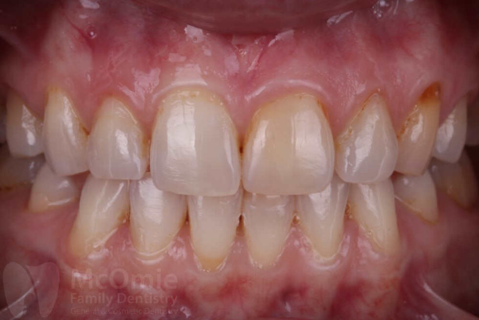 Veneers Patient Before and Afters - McOmie Family Dentistry