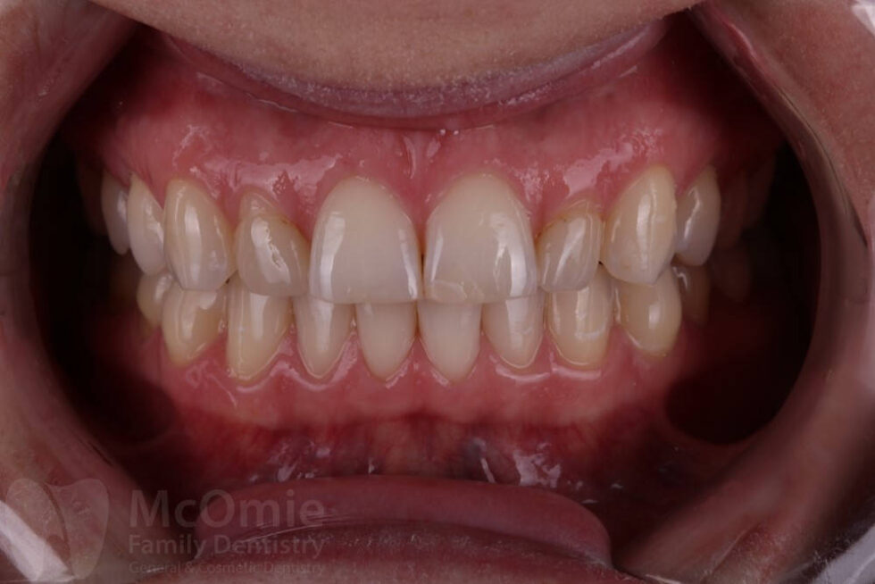 Veneers Patient Before and Afters - McOmie Dentistry Chattanooga