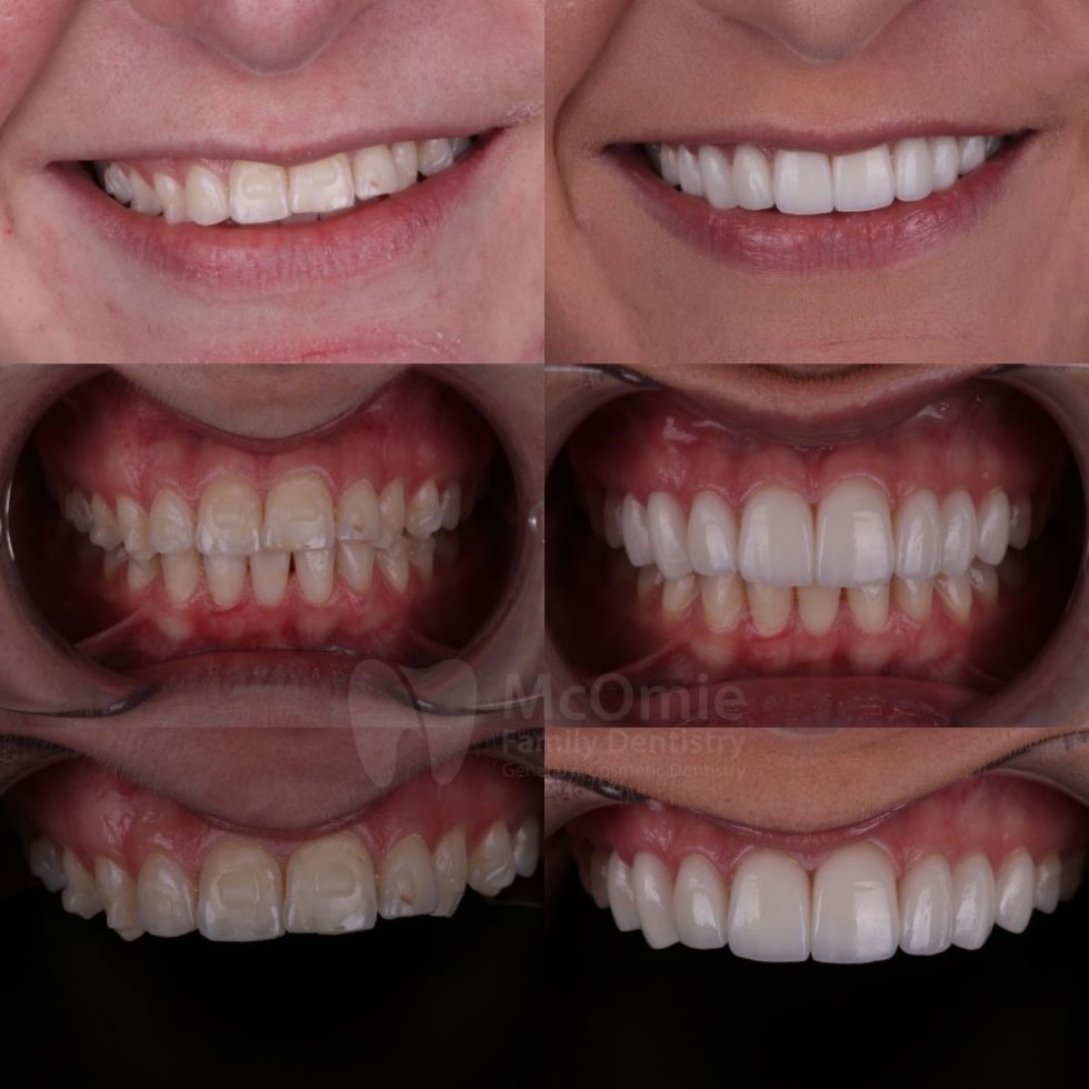 Veneers Patient Before and Afters - McOmie Family Dentistry