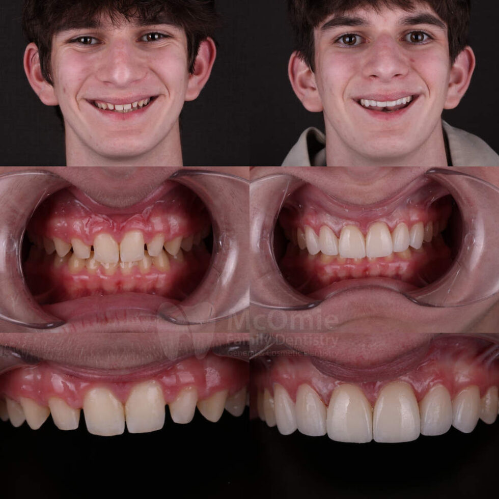Veneers Patient Before and Afters - McOmie Family Dentistry