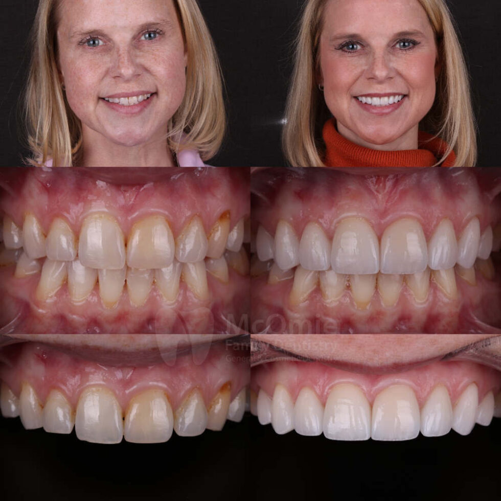 Veneers Patient Before and Afters - McOmie Family Dentistry