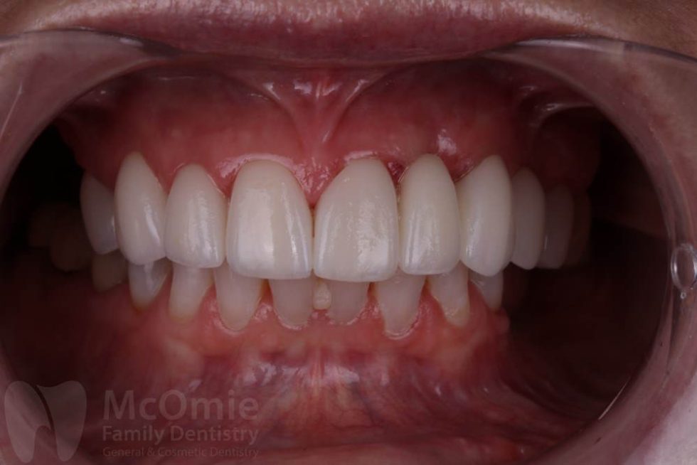 Full Mouth Reconstruction Patient Before and Afters - McOmie Family ...