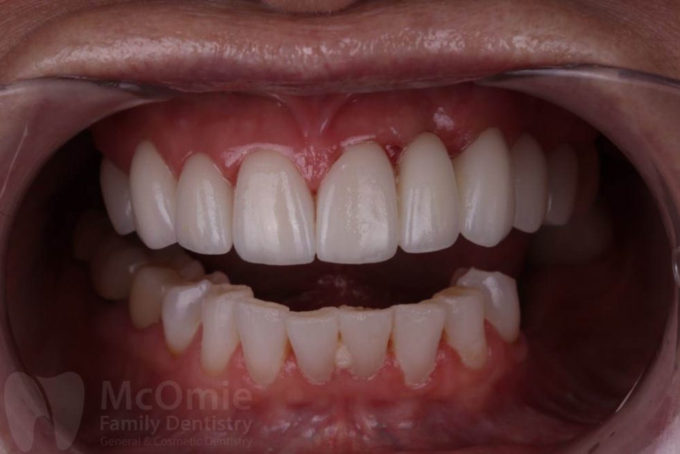 Full Mouth Reconstruction Patient Before and Afters - McOmie Family ...