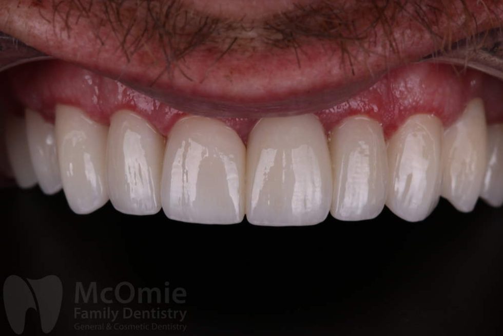 Full Mouth Reconstruction Patient Before and Afters - McOmie Family ...