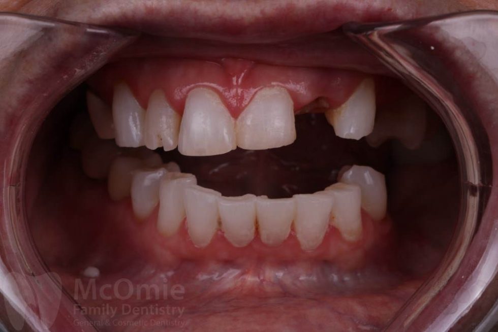 Full Mouth Reconstruction Patient Before and Afters - McOmie Family ...