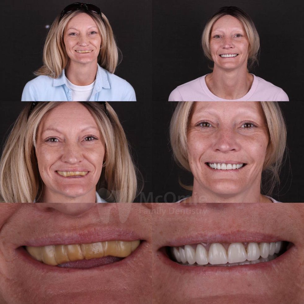 Full Mouth Reconstruction Patient Before and Afters - McOmie Family ...