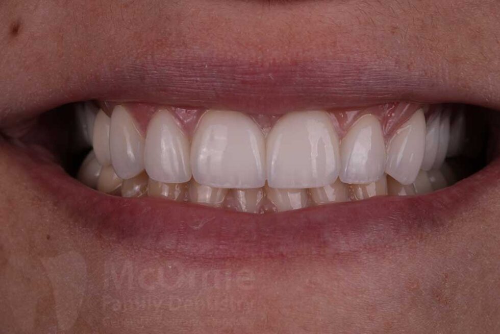 Full Mouth Reconstruction Patient Before and Afters - McOmie Family ...