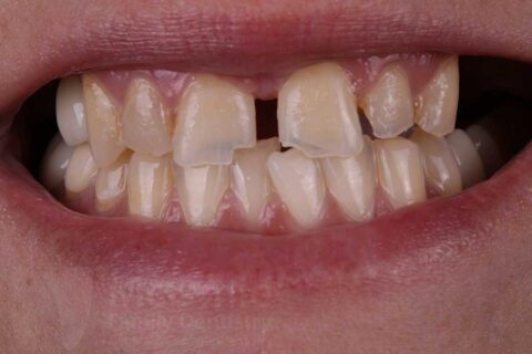 Full Mouth Reconstruction Patient Before and Afters - McOmie Family ...