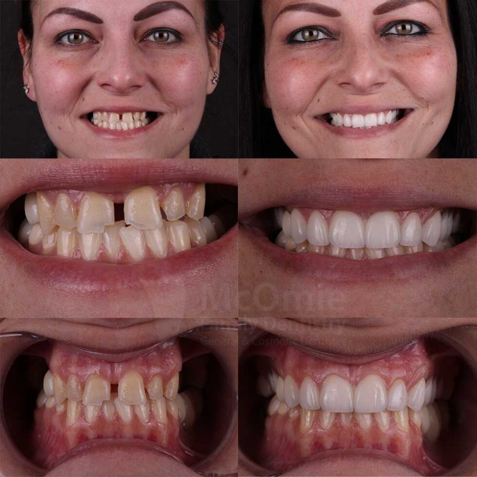 Full Mouth Reconstruction Patient Before and Afters - McOmie Family ...