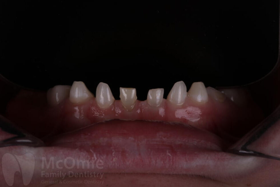 Full Mouth Reconstruction Patient Before and Afters - McOmie Dentistry ...