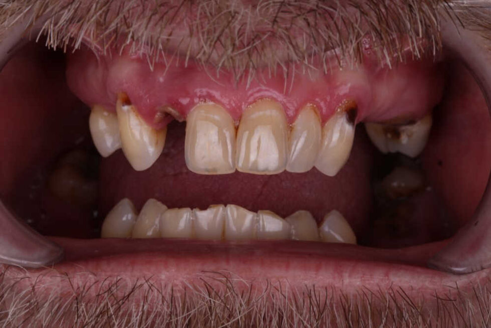 Full Mouth Reconstruction Patient Before and Afters - McOmie Dentistry ...