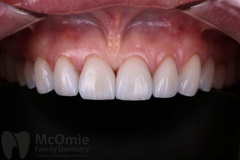 Veneers Patient Before and Afters - McOmie Dentistry Chattanooga